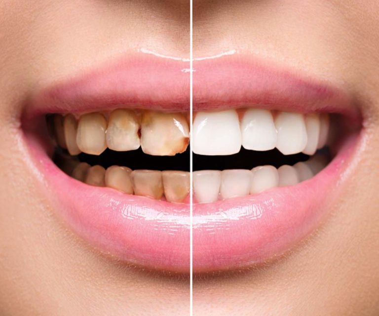 Immediate/Surgical Dentures - Edmonton South Centre Denture Clinic Immediate/Surgical Dentures - Edmonton South Centre Denture Clinic