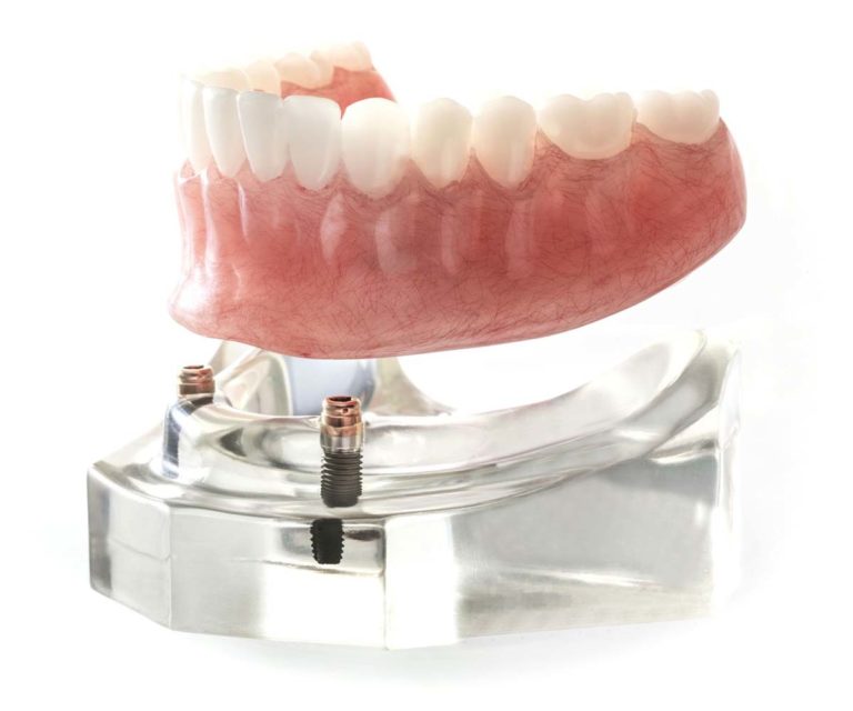 Implant Supported Dentures - Edmonton South Centre Denture Clinic